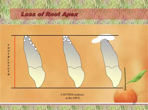 ROOT RESORPTION IN ORTHODONTICS PPT Bone And Joint Conditions Diseases And Conditions