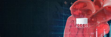 Calculated Decisions For Tmvr Using 3d Planning Materialise