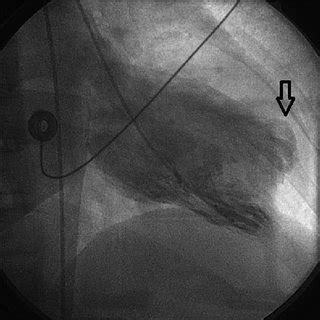 Left Ventriculography Right Anterior Oblique Cranial View Download Scientific Diagram