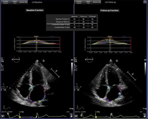 Left Atrial Strain Imaging Download Scientific Diagram