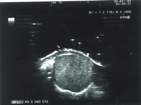 To Evaluate The Vascular Features Of The Lesion Usg Was Performed Download Scientific Diagram