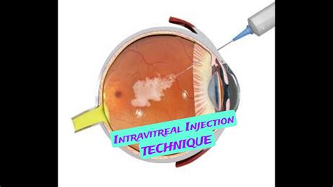 INTRAVITREAL INJECTION Technique Procedure For Giving INJECTIONS Inside The EYE YouTube