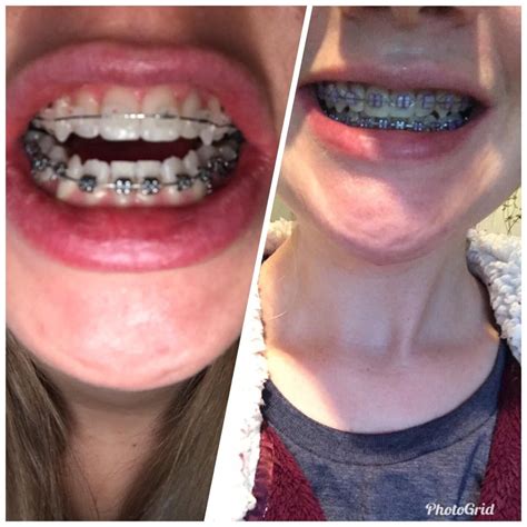 Double Jaw Surgery Before And After Had A Class 3 Open Bite 3 Months Post Op And Finally