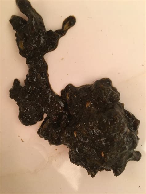 上消化道出血粪便图片 上消化道出血黑便图片 伤感说说吧