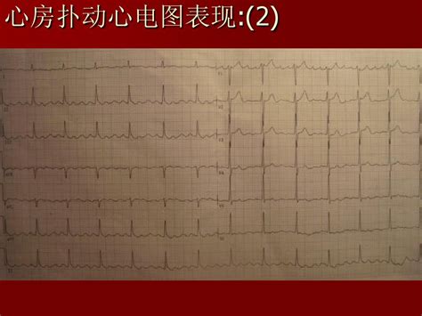 心房扑动的心电图 word文档在线阅读与下载 无忧文档