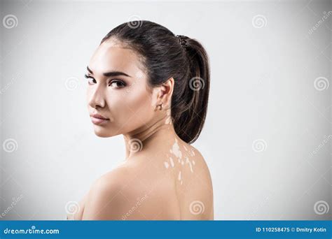 Portrait Of Beautiful Woman With Vitiligo Stock Image Image Of Adult Face 110258475