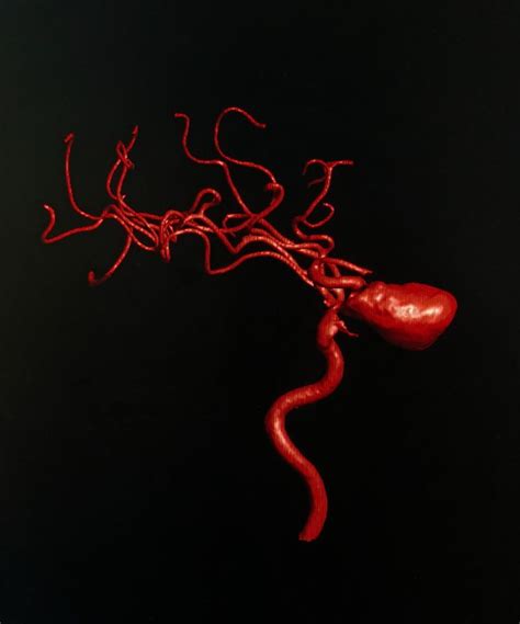 Cavernous Segment Aneurysm Machine Philips Alluera Xper Fd20 Technique… Ashish Mohan V P