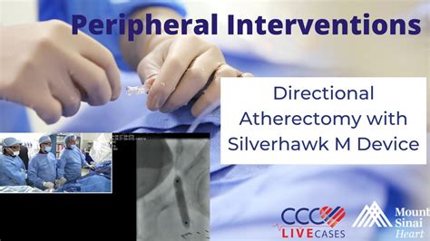 Directional Atherectomy With Silverhawk M Device January 24 2018 Youtube