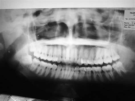 Impacted Tooth Angelique Smile Dental Center