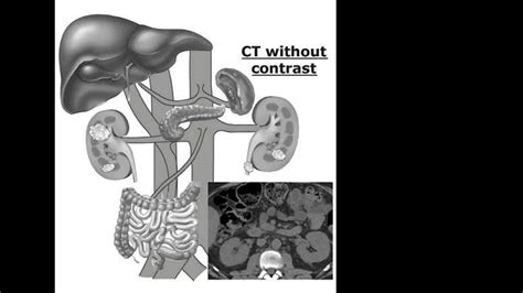 Liver Segment Anatomy Ct Scan Pptx