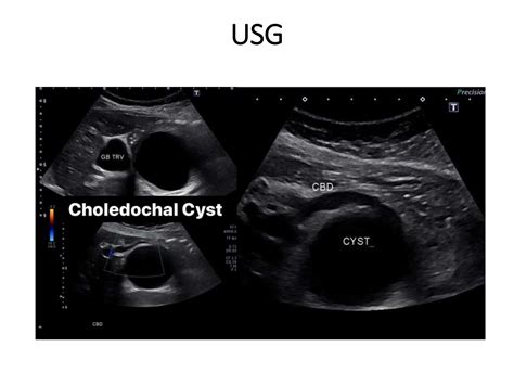 Choledochal Cyst And Biliary Atresiapptx