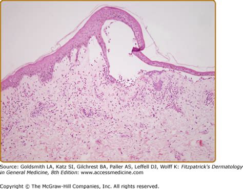 Pemphigoid Histology