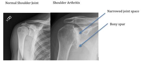 Sameer Singh Shoulder Arthritis