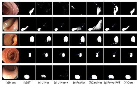Segt Separated Edge Guidance Transformer Network For Polyp Segmentation
