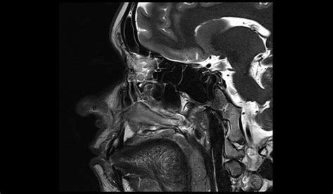 Mri Cisternography Csf Rhinorrhea Csf Rhinorrhea Mri Protocol And Planning