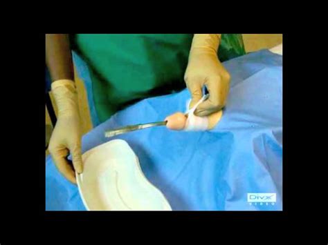 Epidydimitis YouTube