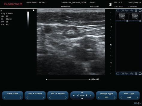 Triangle Made By The Gsv Lymph Node And Deep Veins Download