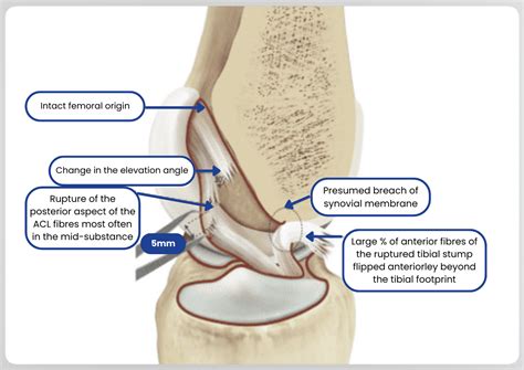 Acl Healing And The Cross Bracing Protocol Rusutsu Physio