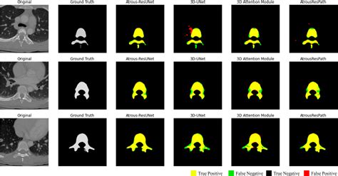 Atrous Residual Interconnected Encoder To Attention Decoder Framework For Vertebrae Segmentation
