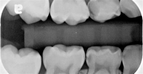 Bitewing X Ray Dental Album On Imgur