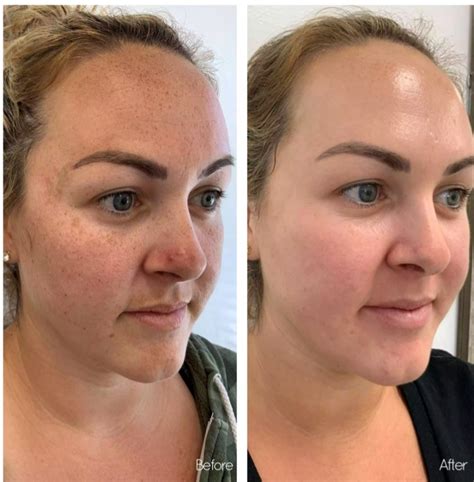 Bioptron Light Therapy Chillrx Cryotherapy Montclair