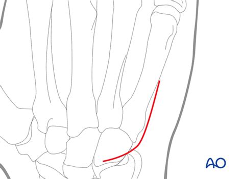 Dorsal Approach To The 5th Carpometacarpal Joint