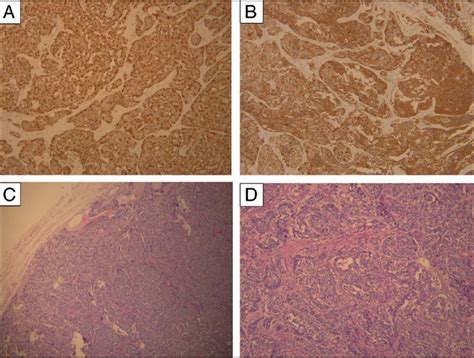 A Chromogranin A Stain B Synaptophysin Stain C Lumen Of The