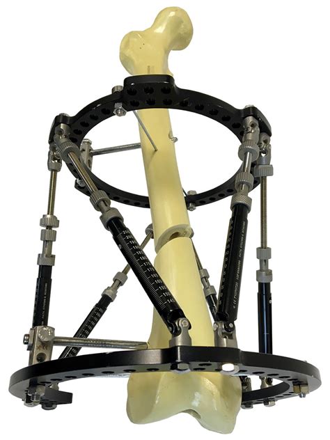 Mackie Orthopaedics Bone Deformity Correction