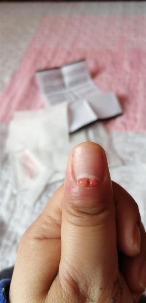 Granuloma Piogenico Ungueal Tumores Pie Foot Tumours