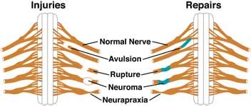 Brachial Plexus Injury Symptoms Treatment And Surgery