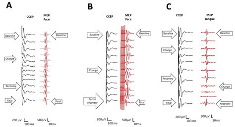 Intraoperative Cortico Cortical Evoked Potentials For Monitoring Language Function