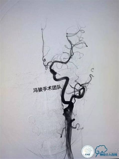 双侧颈动脉高危病变，分期手术及随访 每日头条