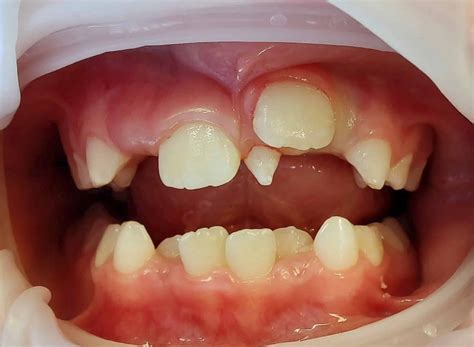 Orthodontic Implications Of Extra Teeth What You Need To Know