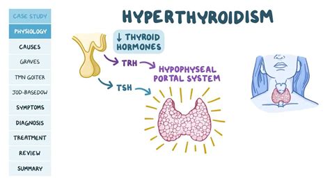 Hyperthyroidism Causes