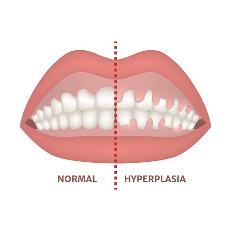 Managing Drug Induced Gingival Hyperplasia The Probe Cpd Portal