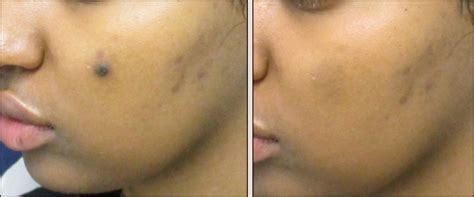 Intradermal Nevus Removal