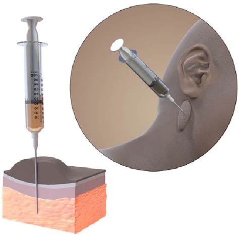 Figure 3 From Intralesional Cryotherapy For Hypertrophic Scars And