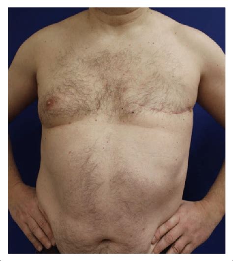 Postoperative Result Patient 6 Months Later After Simple Mastectomy Download Scientific
