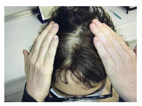 Selenium Toxicity Causing Hair Loss — Donovan Hair Clinic