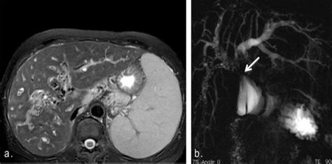 A 46years Old Female Patient Who Had A Past History Of Download