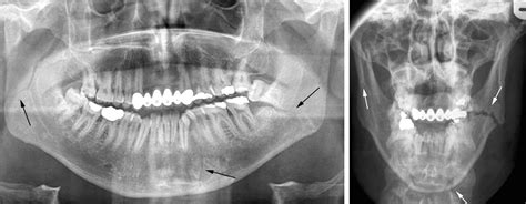 Mandibular Fracture X Ray
