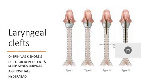 Laryngology Laryngeal Clefts Dr Srinivas Kishore Youtube