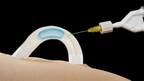 Así Funciona El Diu Para Hombres Que Podría Reemplazar A La Vasectomía