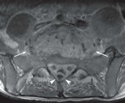 Pyogenic Discitis And Epidural Abscess Radiology Key