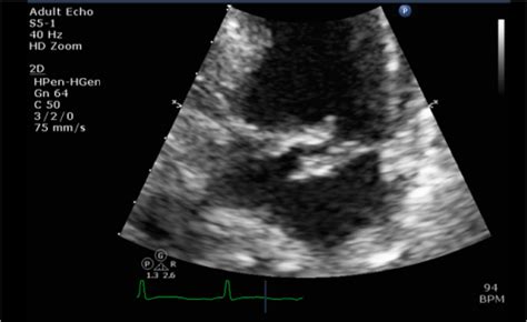Not The Usual Suspect A Case Of Staphylococcus Lugdunensis Infective Endocarditis