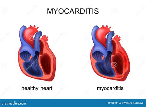 Heart Healthy And Diseased Myocarditis Stock Vector Illustration Of Endocarditis Health 96891158
