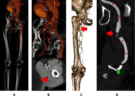 Endovascular Stent Graft Repair Of A Persistent Sciatic Artery Aneurysm Pmc