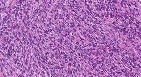 Dermatofibrosarcoma Protuberans Ottawa Atlas Of Pathology