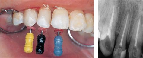 8 Emergency Endodontics Pocket Dentistry