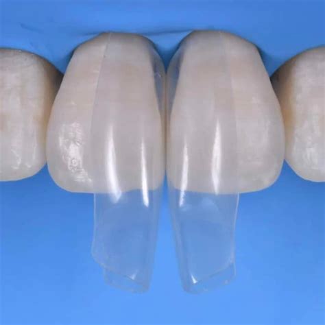 The Bioclear Hd Anterior Matrix Bioclear Matrix System